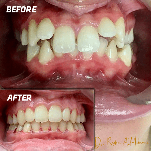 Photos of Before & After Invisalign Treatment|Dr Rasha AlMubarak