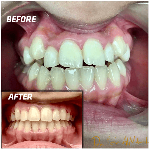 Photos of Before & After Invisalign Treatment|Dr Rasha AlMubarak