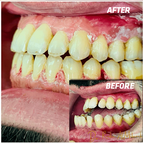 Photos of Before & After Invisalign Treatment|Dr Rasha AlMubarak