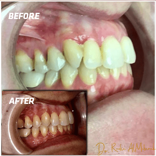 Photos of Before & After Invisalign Treatment|Dr Rasha AlMubarak