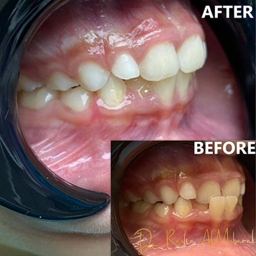 Photos of Before & After Invisalign Treatment|Dr Rasha AlMubarak